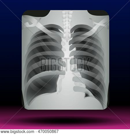 Chest X-ray Scan - Image & Photo (Free Trial) | Bigstock