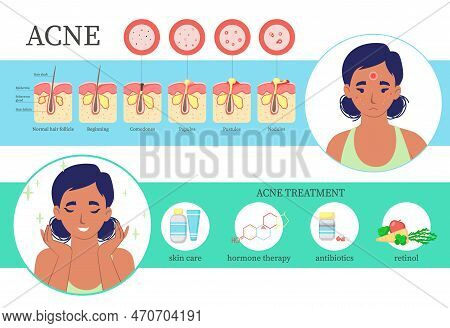 Acne Flat Vector Face Vector & Photo (Free Trial) | Bigstock