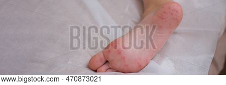 Child Foot Red Itchy Image & Photo (Free Trial) | Bigstock