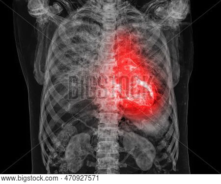 Human Heart Attack Image & Photo (Free Trial) | Bigstock