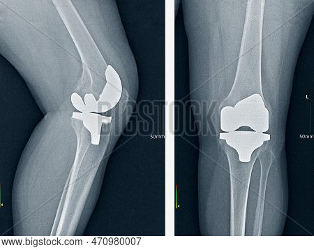 X-ray Left Knee Joint Image & Photo (Free Trial) | Bigstock