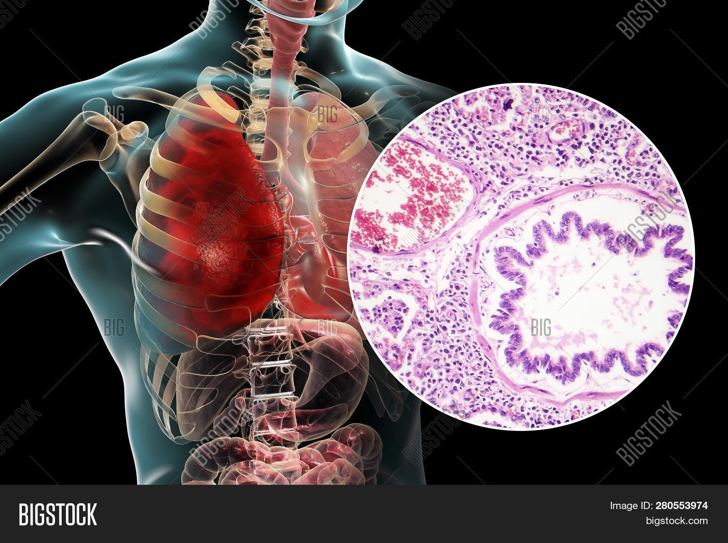 Lobar Pneumonia Red Image And Photo Free Trial Bigstock
