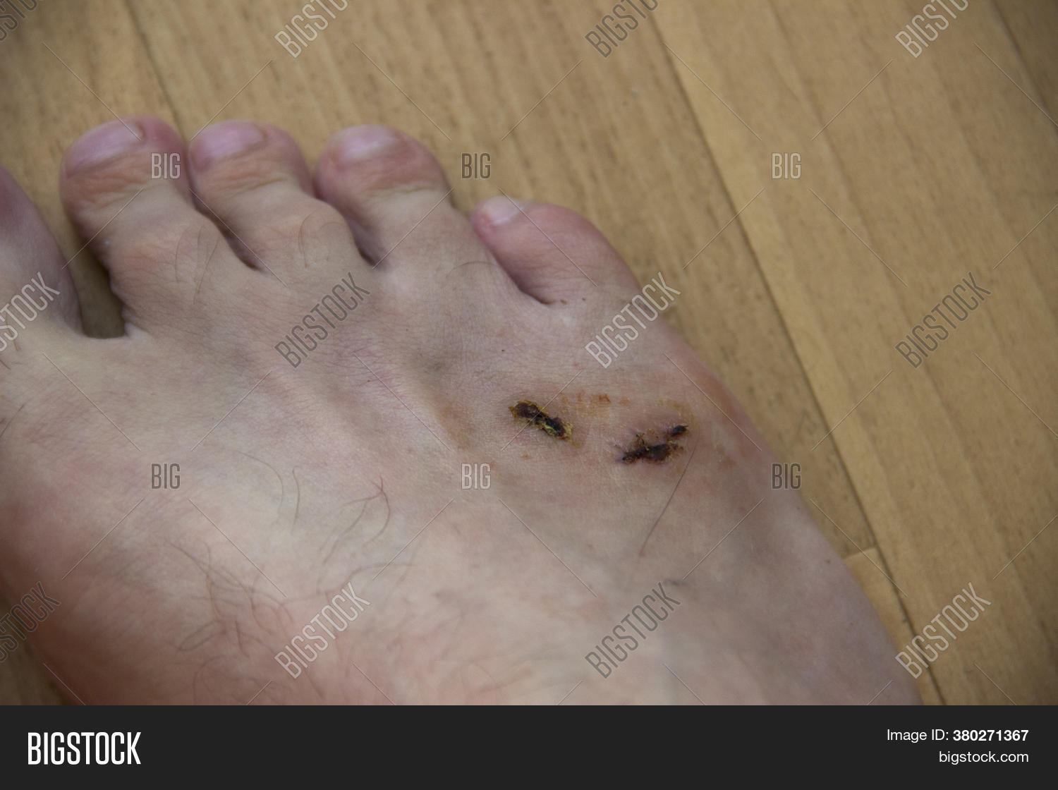 Sick Leg Wounds On Image & Photo (Free Trial) | Bigstock
