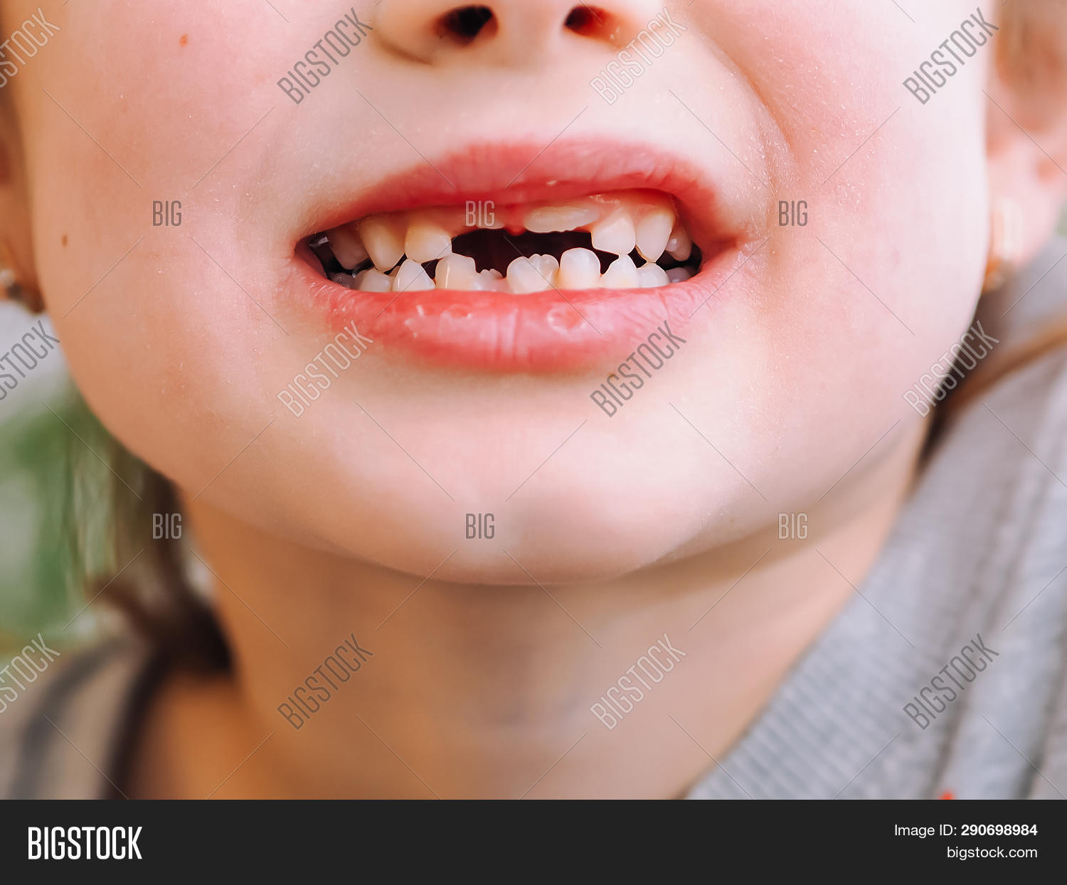 Child Has Milk Tooth Image & Photo (Free Trial) | Bigstock