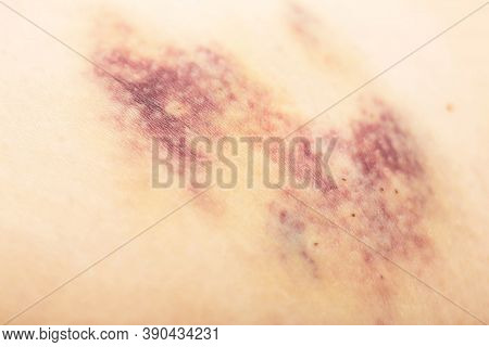 Bruises On Patients Image & Photo (Free Trial) | Bigstock