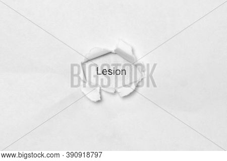 Word Lesion On White Image & Photo (Free Trial) | Bigstock