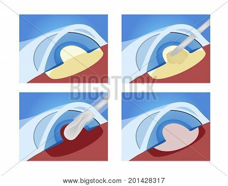 Cataracts Surgery Vector & Photo (Free Trial) | Bigstock