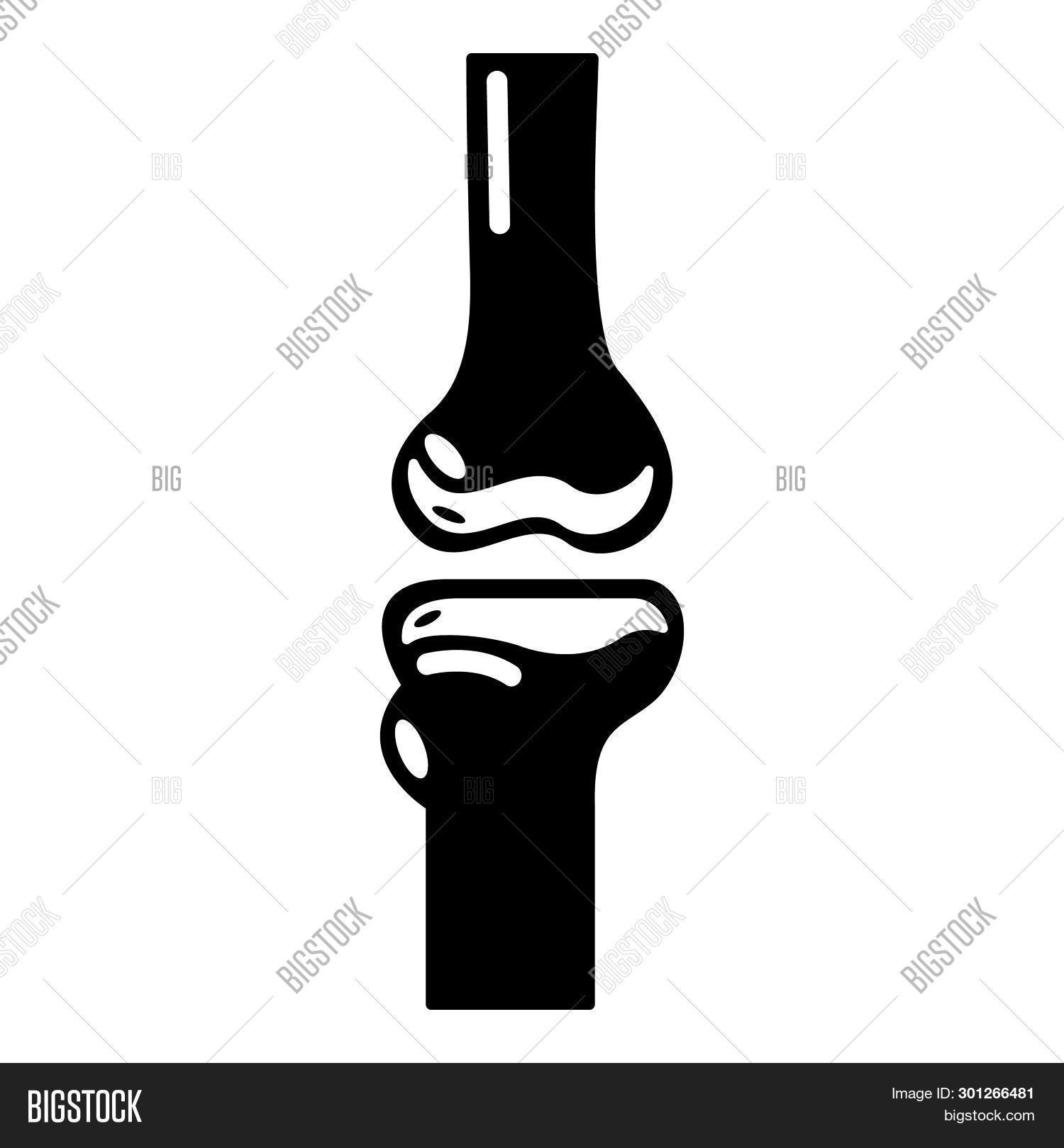 Joint Inflammation Image & Photo (Free Trial) | Bigstock