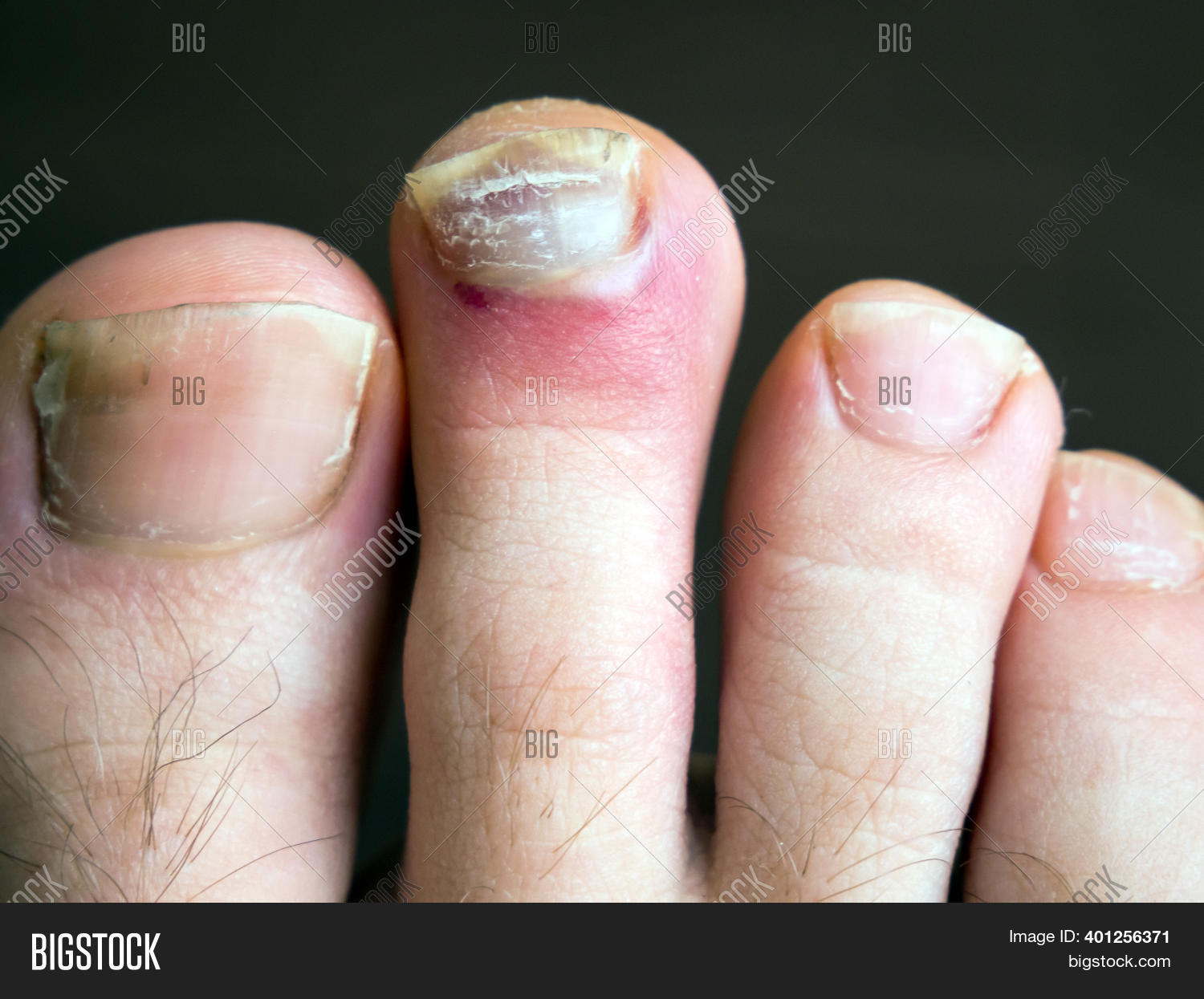 Purulent Abscess Near Image & Photo (Free Trial) | Bigstock