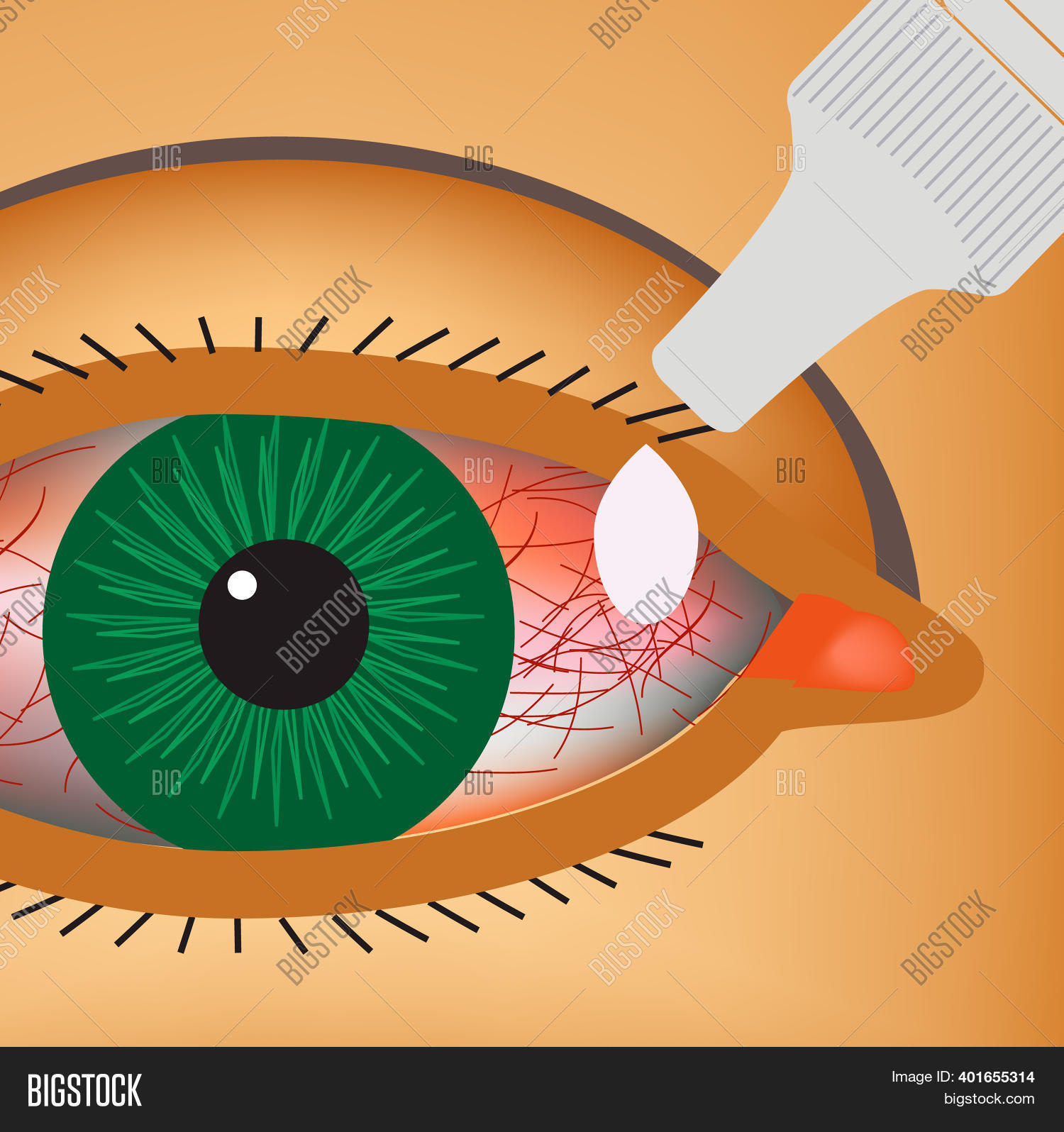 Conjunctivitis. Image & Photo (Free Trial) | Bigstock