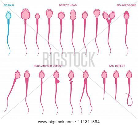 Normal Abnormal Sperm Vector & Photo (Free Trial) | Bigstock