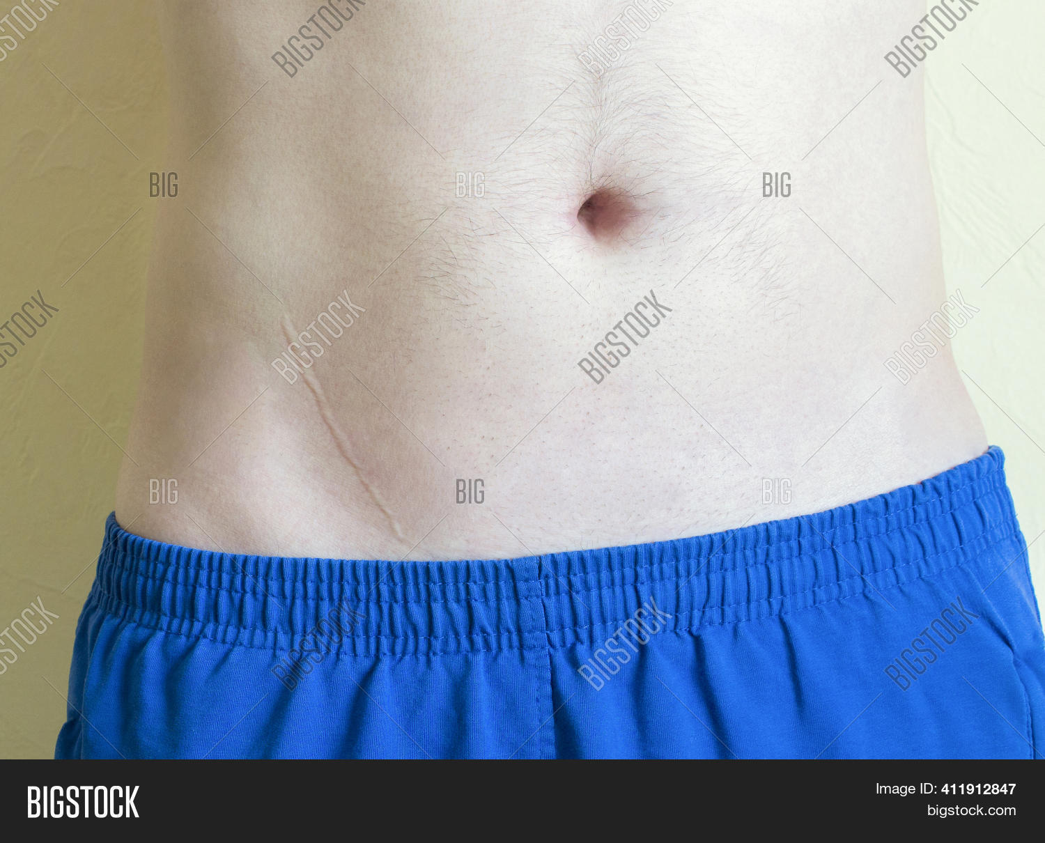 Appendicitis Scar Belly Button
