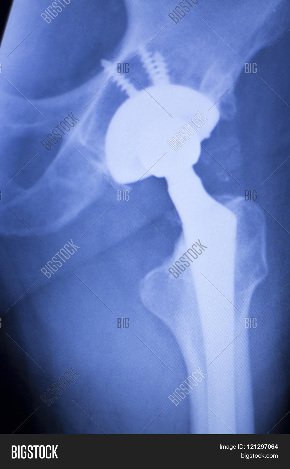 Hip Replacement Xray Image & Photo (Free Trial) | Bigstock