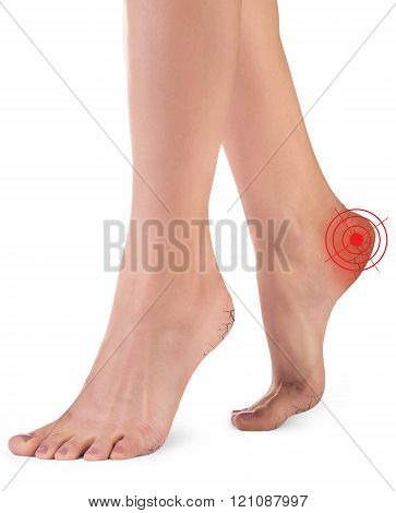 Female Legs Cracks Image & Photo (Free Trial) | Bigstock