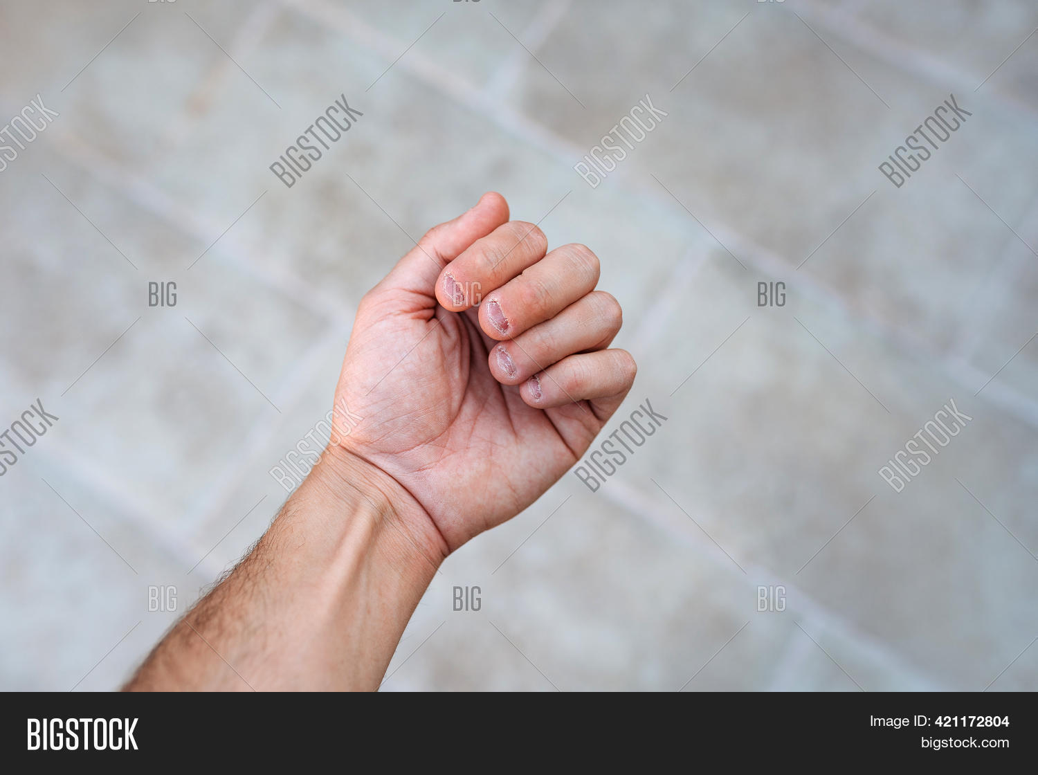 Man's Hand Bitten Ugly Image & Photo (Free Trial) | Bigstock