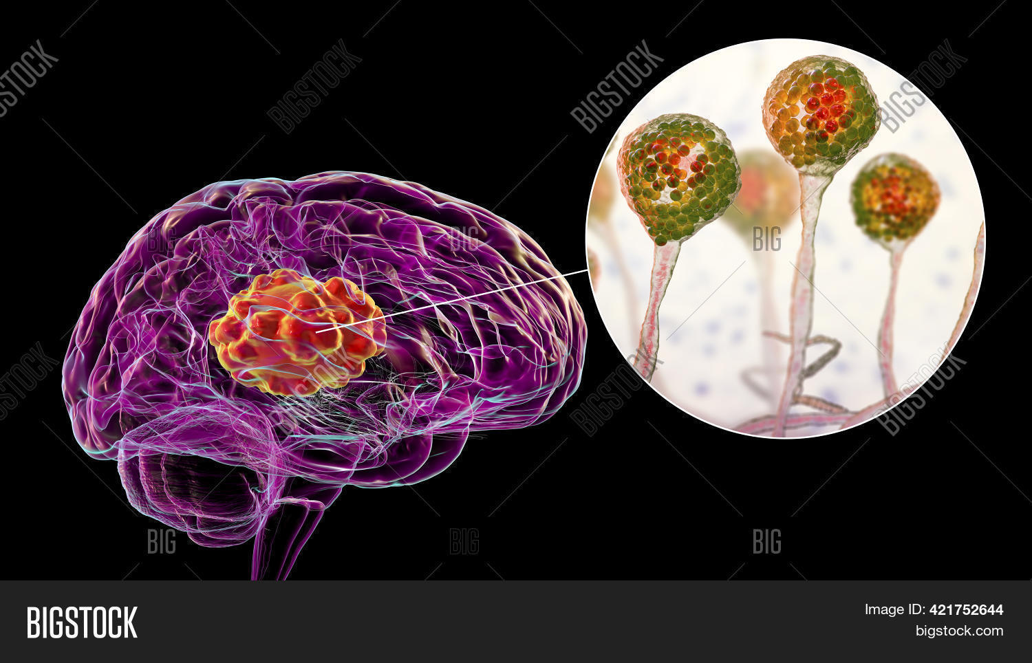 Brain Mucormycosis, Image & Photo (Free Trial) | Bigstock