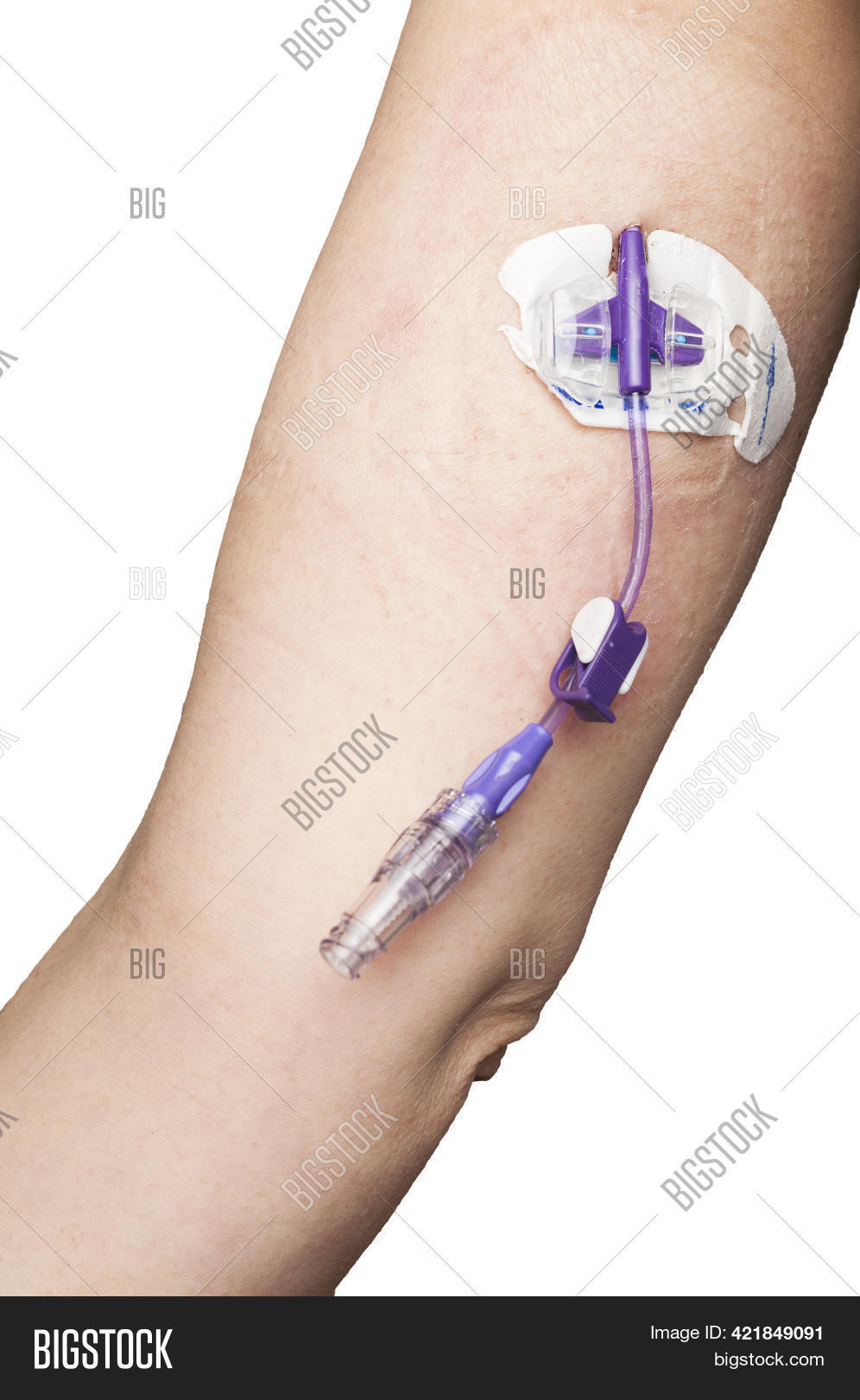 Picc Line On Arm Woman Image & Photo (Free Trial) | Bigstock