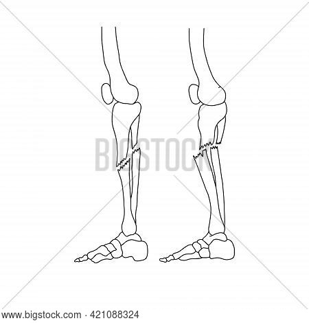 Human Leg Fracture: Vector & Photo (Free Trial) | Bigstock
