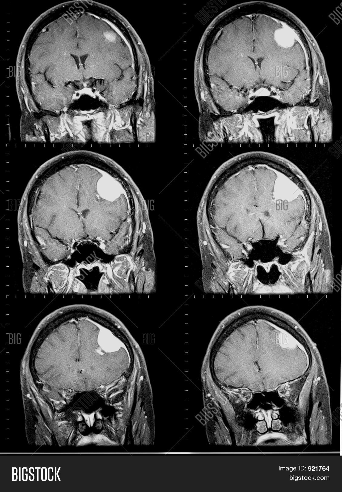 Brain Mri Coronal Image & Photo (Free Trial) | Bigstock