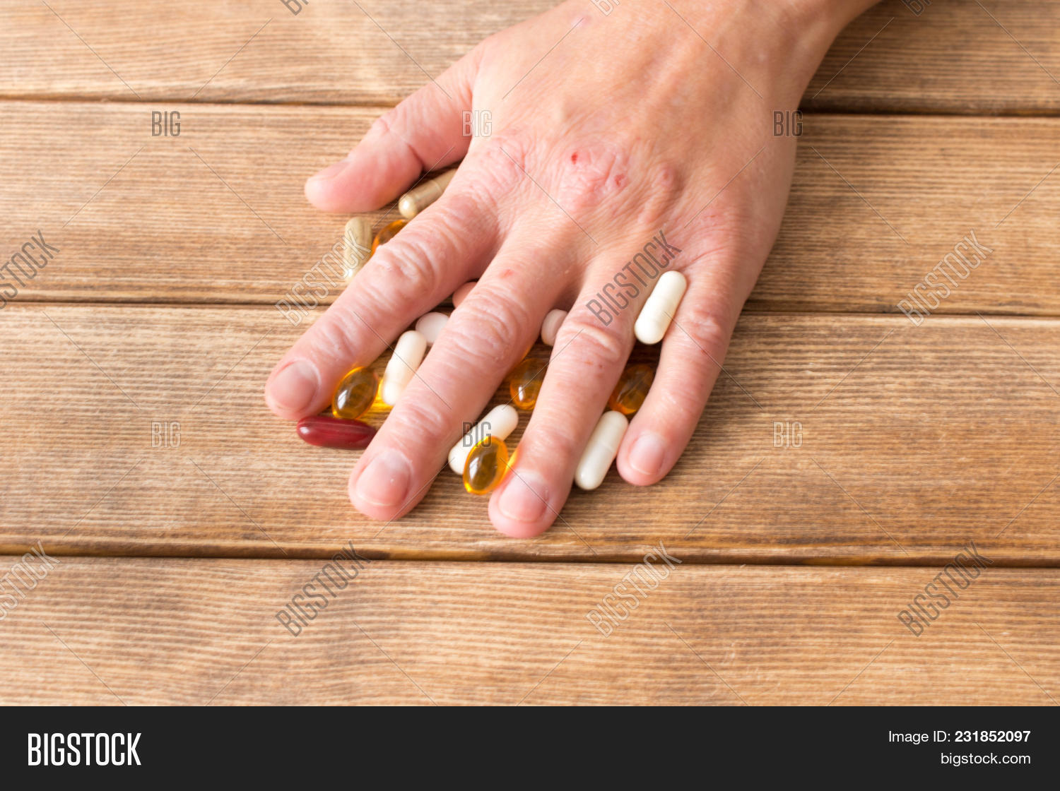 Hands Girl Atopic Image & Photo (Free Trial) | Bigstock