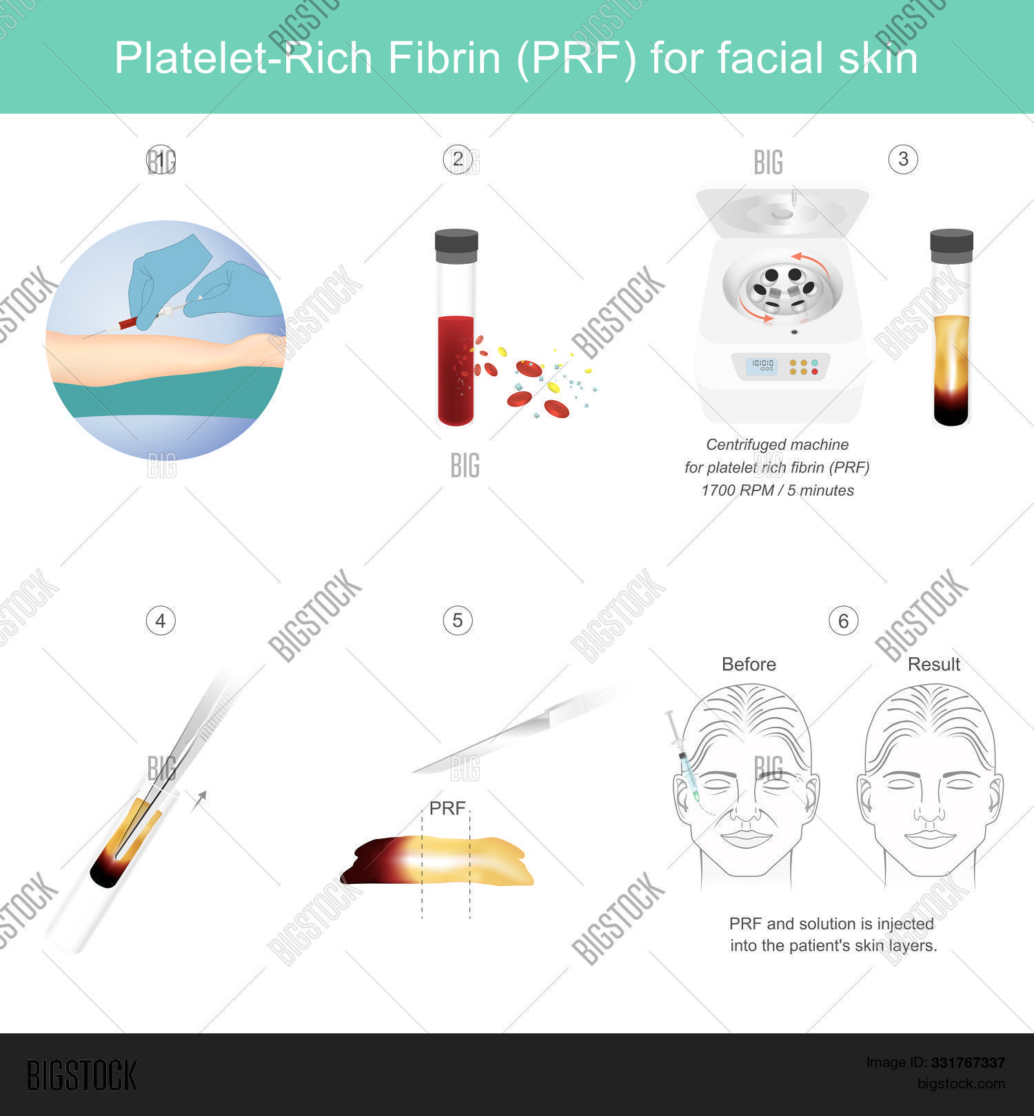 Platelet Rich Fibrin Vector & Photo (Free Trial) | Bigstock