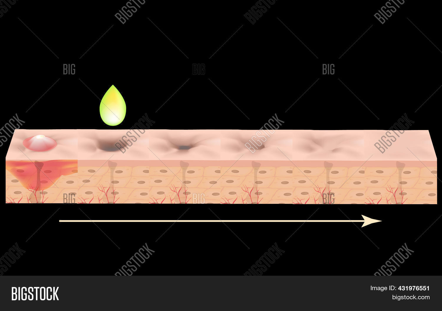 Atrophic Scars. Acne Image & Photo (Free Trial) | Bigstock