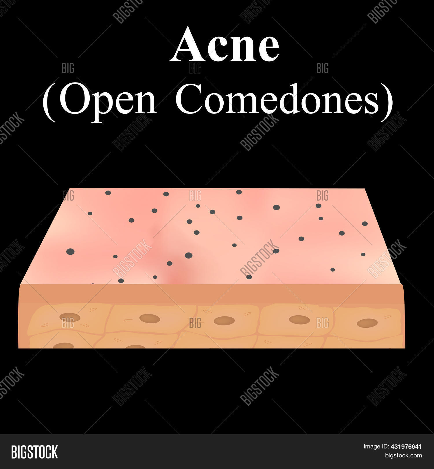 Open Comedones. Acne Image & Photo (Free Trial) | Bigstock