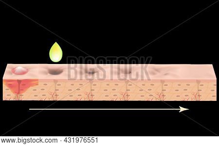 Atrophic Scars. Acne Image & Photo (Free Trial) | Bigstock
