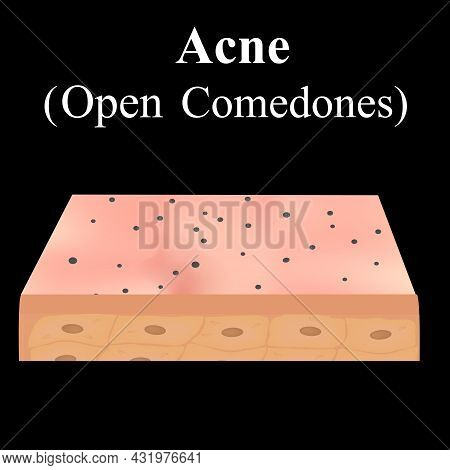 Open Comedones. Acne Image & Photo (Free Trial) | Bigstock