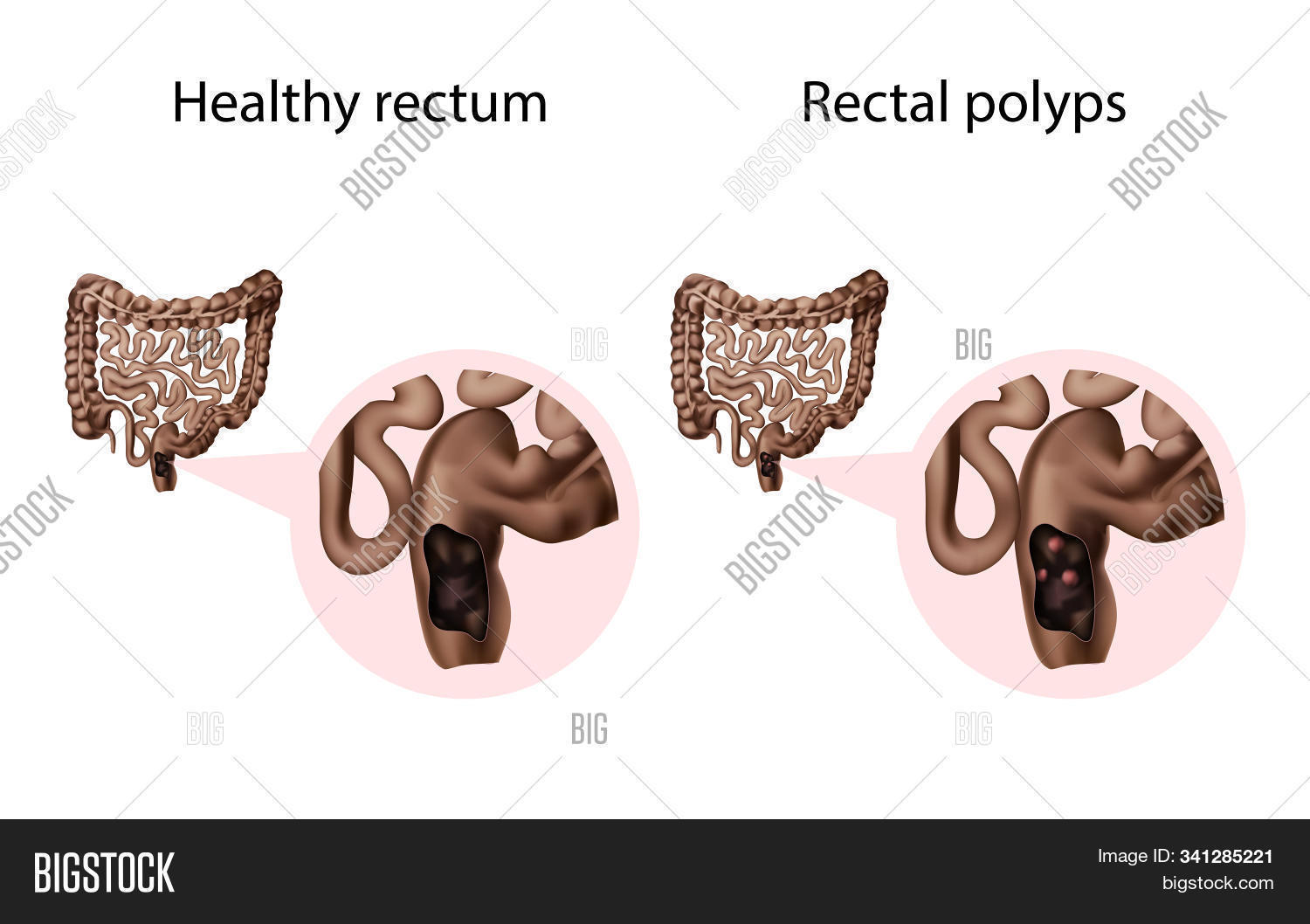 Rectal Polyps Healthy Image & Photo (Free Trial) | Bigstock