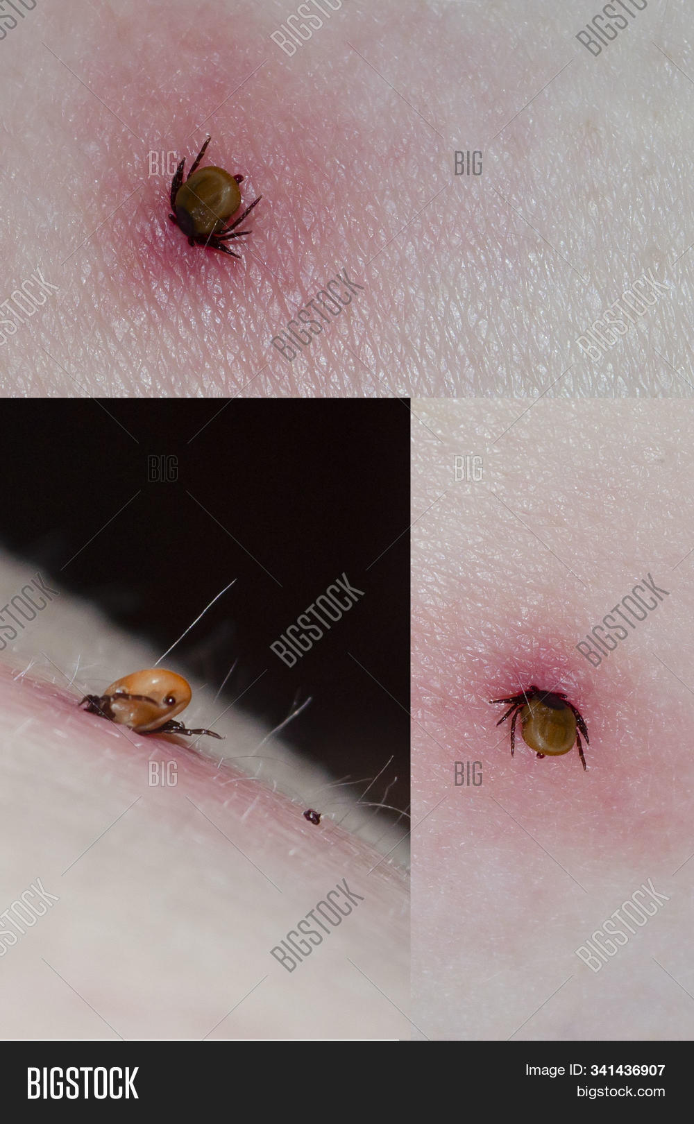 Mite On Human Skin. Image & Photo (Free Trial) | Bigstock