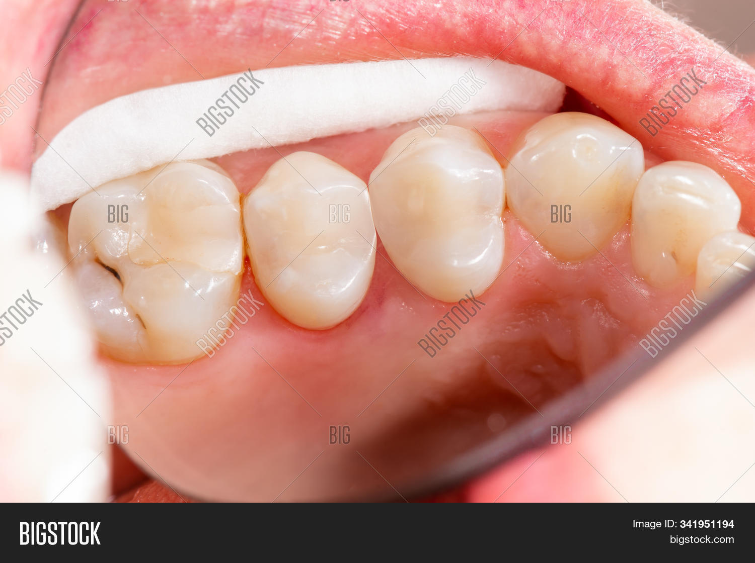 Two Chewing Side Teeth Image & Photo (Free Trial) | Bigstock