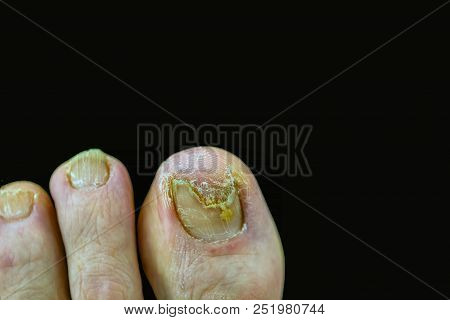Big Toe Toenail Eaten Image & Photo (Free Trial) | Bigstock