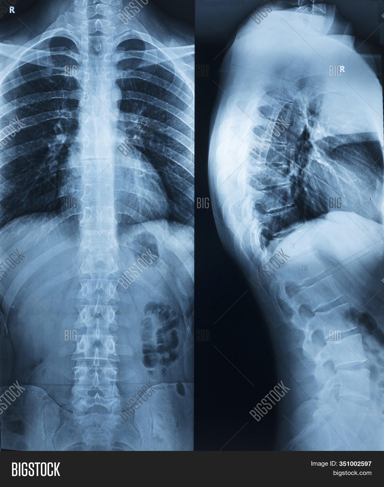 X-ray Spine Man Stoop Image & Photo (Free Trial) | Bigstock