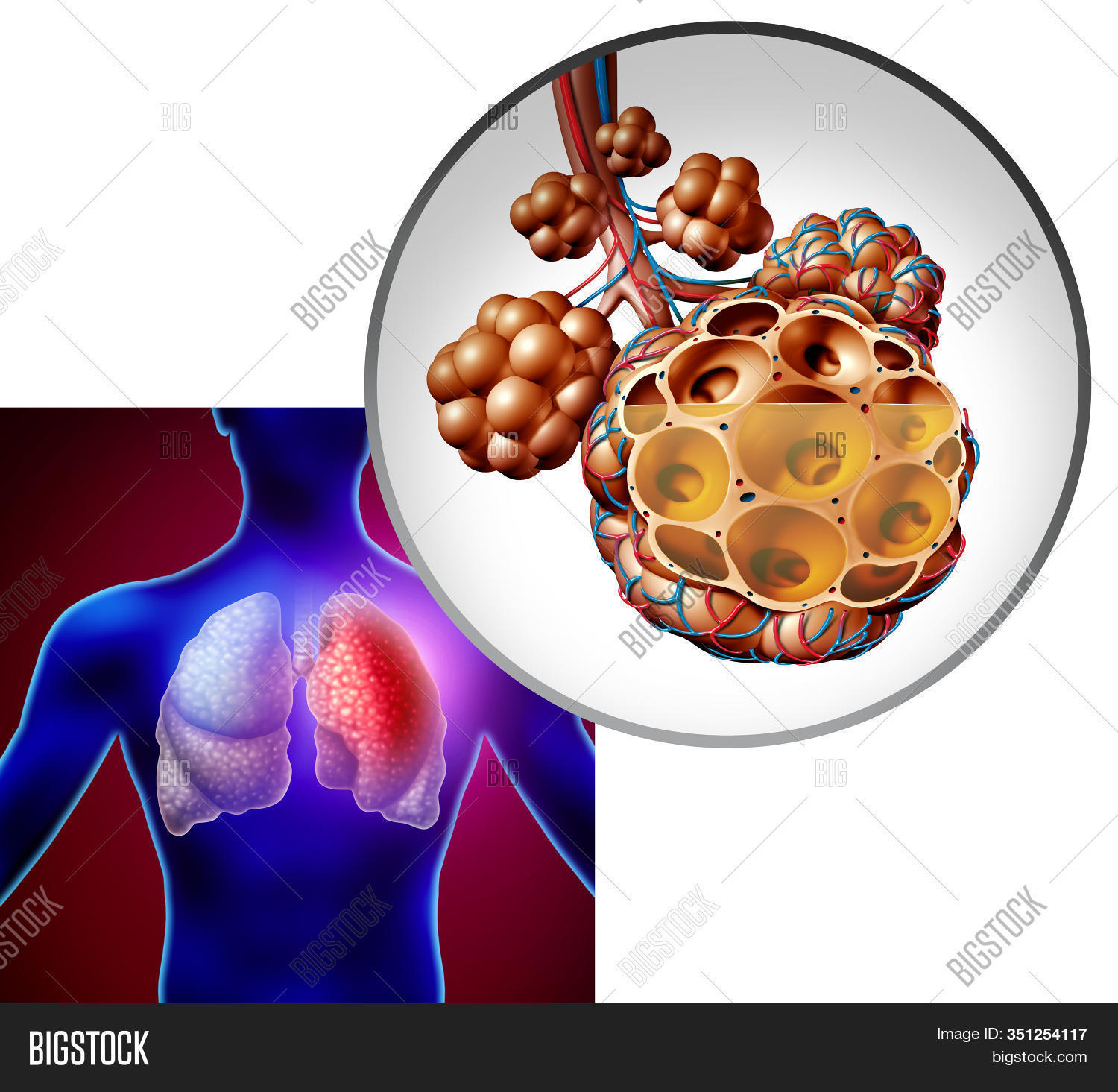 Human Lung Infection Image & Photo (Free Trial) | Bigstock