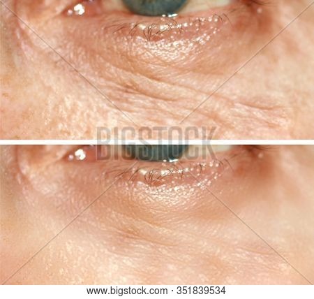 Wrinkles Under Eyes. Image & Photo (Free Trial) | Bigstock