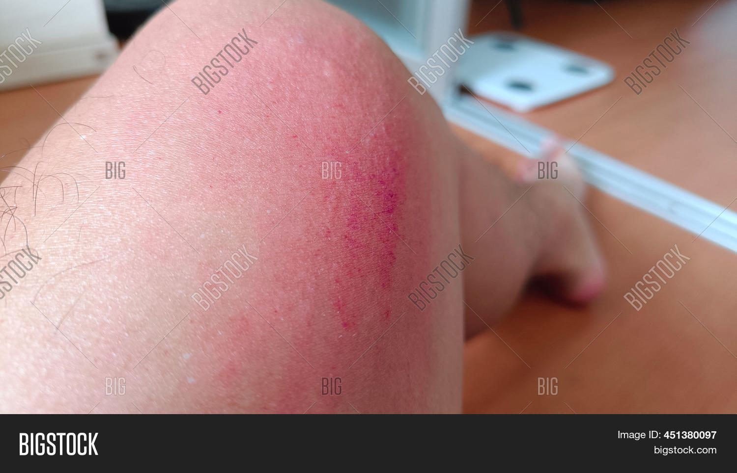Bleeding Leg Deep Image & Photo (Free Trial) | Bigstock