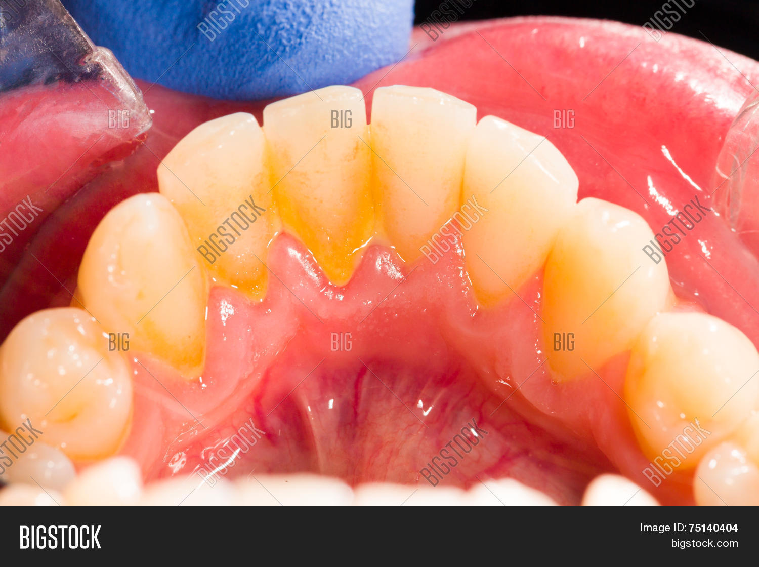 Dental Plaque Image & Photo (Free Trial) | Bigstock
