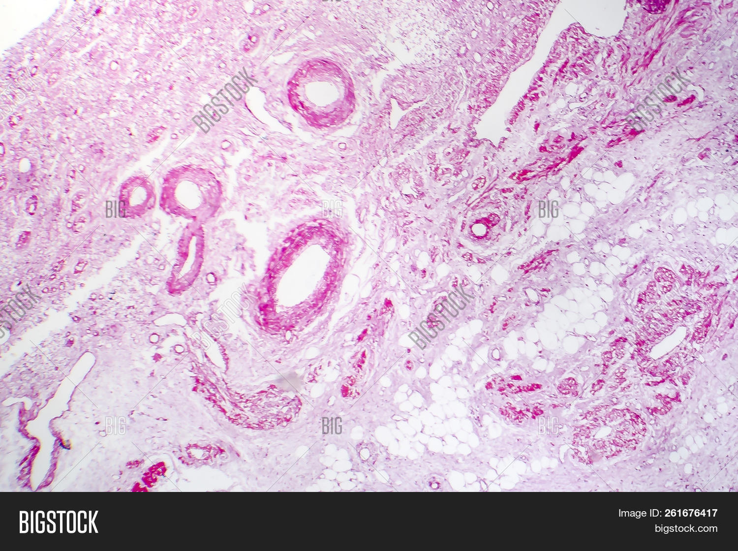 Contracted Kidney, Image & Photo (Free Trial) | Bigstock