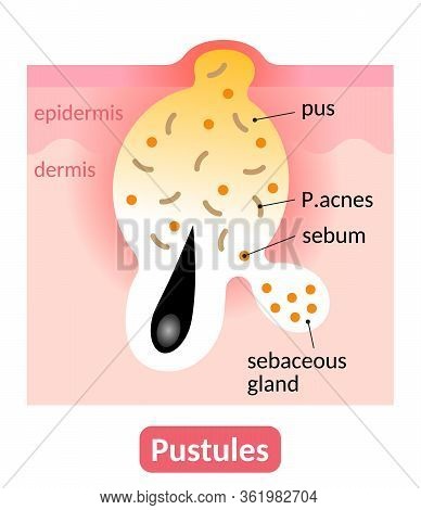 Acne Pustule Inflamed Image & Photo (Free Trial) | Bigstock