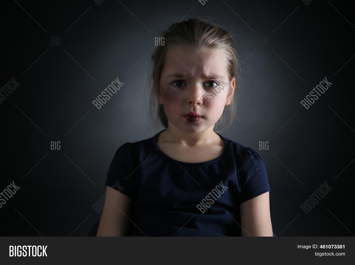 Little Girl Bruises On Image & Photo (Free Trial) | Bigstock