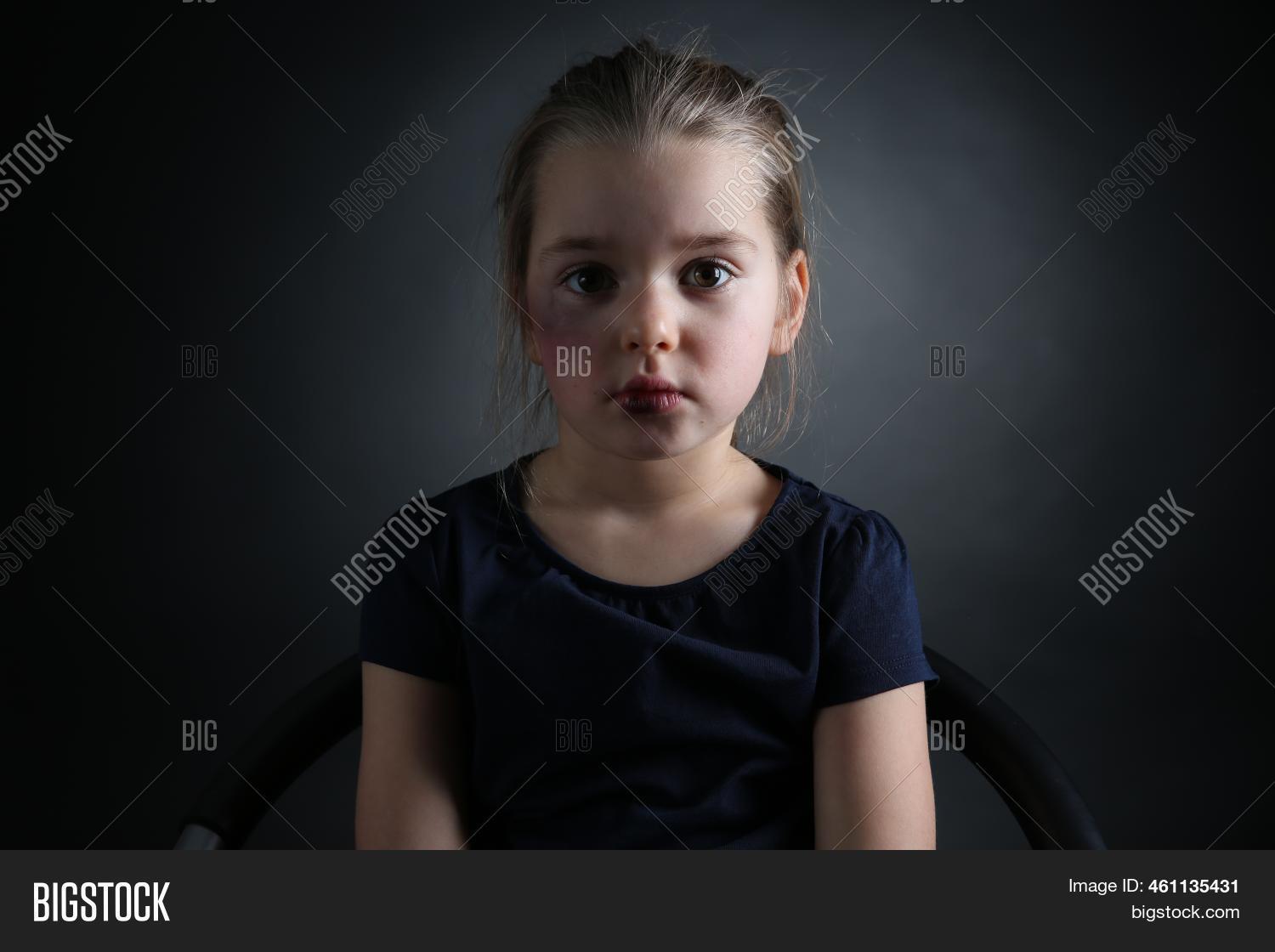 Little Girl Bruises On Image & Photo (Free Trial) | Bigstock