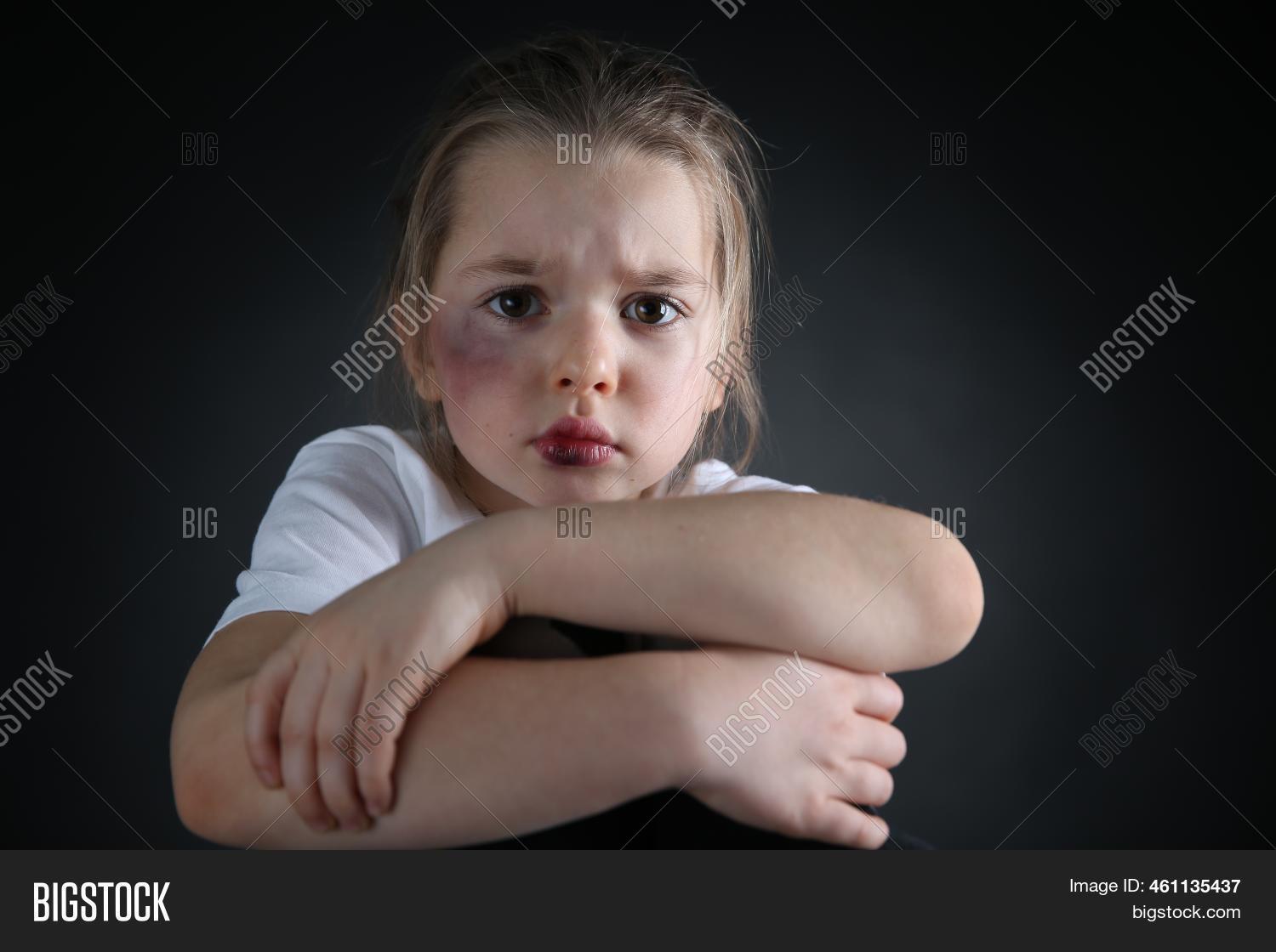 Little Girl Bruises On Image & Photo (Free Trial) | Bigstock