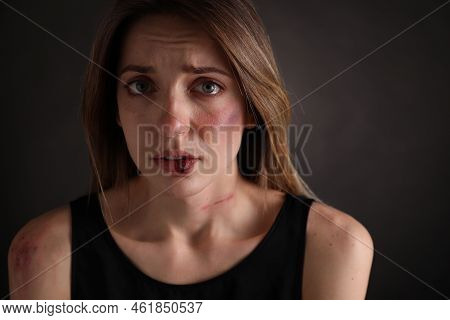 Woman Facial Injuries Image & Photo (Free Trial) | Bigstock