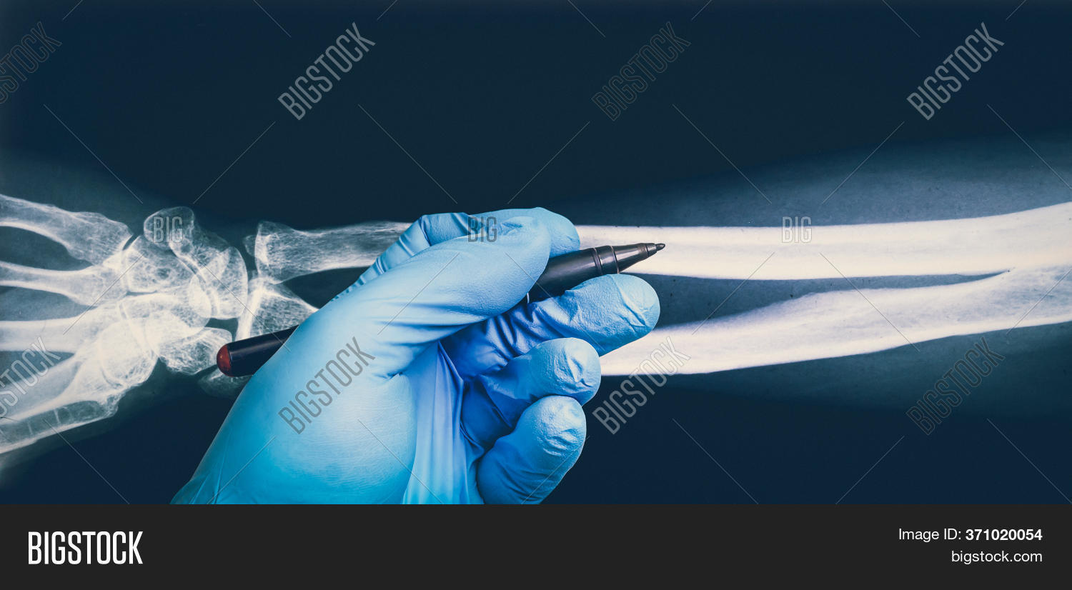 X-ray Human Arm Image & Photo (Free Trial) | Bigstock