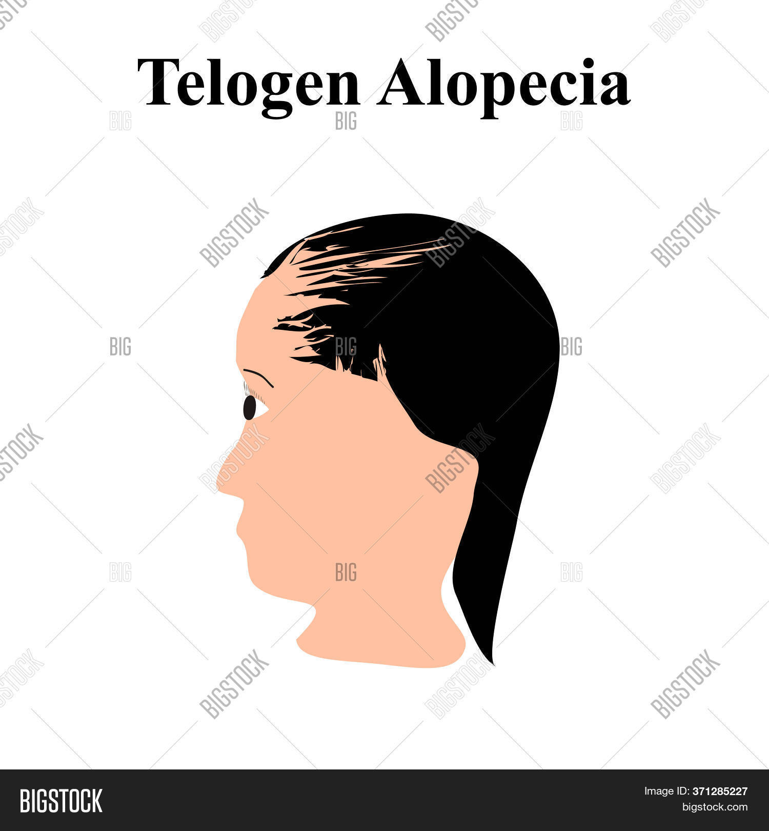 Alopecia Hair. Image & Photo (Free Trial) | Bigstock