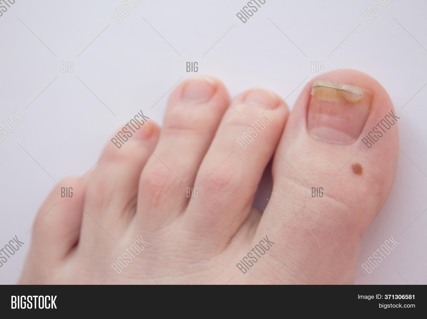 Ingrown Nail Treatment Hand at Lucille Minor blog