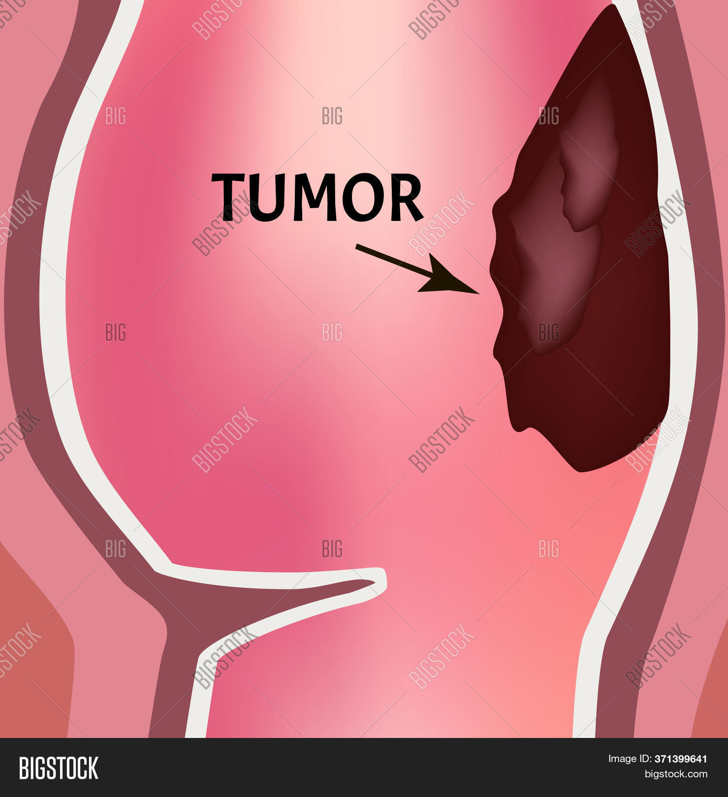 Tumor Rectum. Image & Photo (Free Trial) | Bigstock