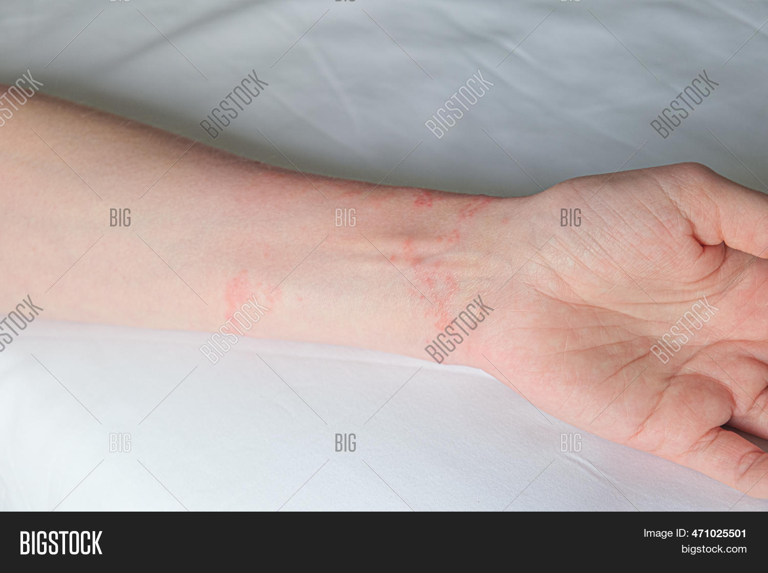 Jellyfish Bite Marks Image & Photo (Free Trial) | Bigstock