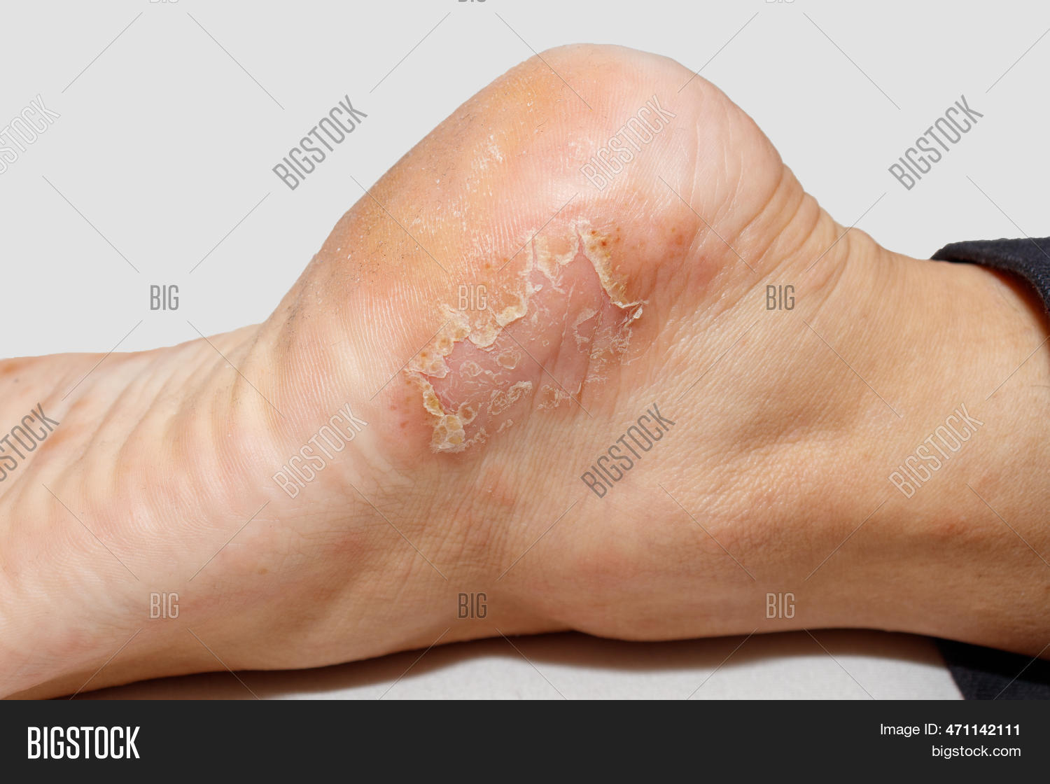 Dyshidrotic Eczema Image & Photo (Free Trial) | Bigstock